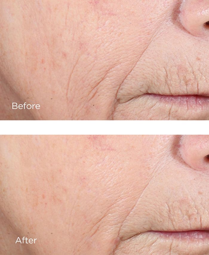 Perricone MD Vitamin C Ester CCC + Ferulic Brightening Complex 20%, 0.5 ...