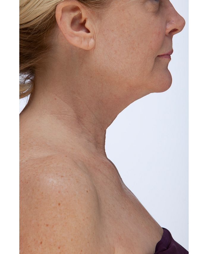 Perricone MD Cold Plasma Sub-D/Neck, 2-oz. - Macy's