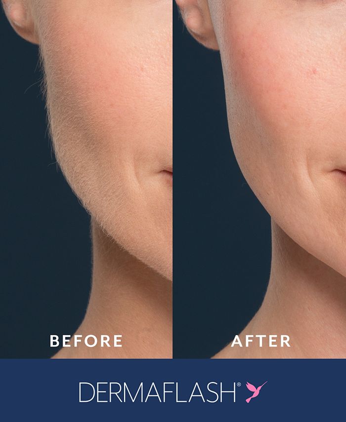 DERMAFLASH 2.0 Luxe Facial Exfoliating Device 5 pc. Set - Macy's