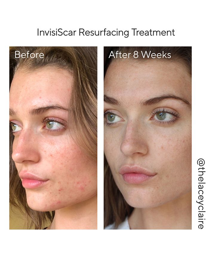 Murad 4-Pc. Acne Control 30-Day Trial Set - Macy's