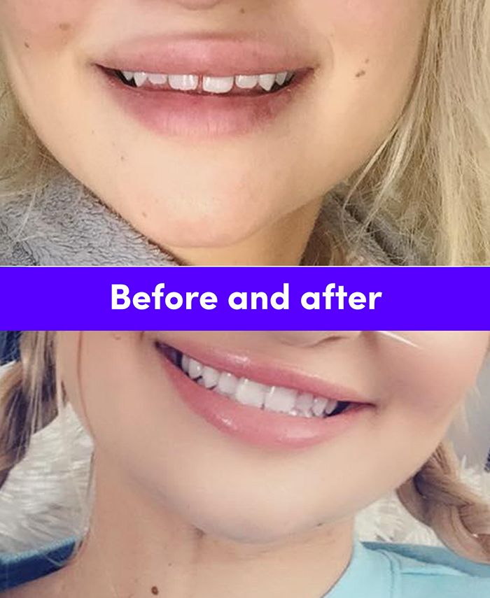 Smile Direct Club New Smile Kit - Macy's