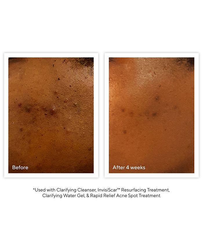 Murad Acne Control Clarifying Cleanser, 6.75-oz. - Macy's