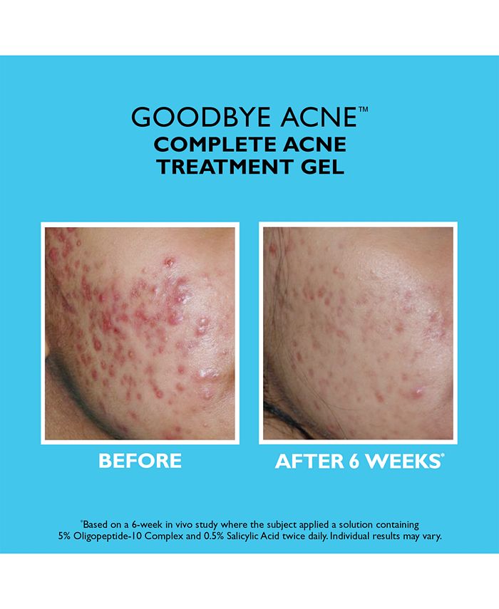Peter Thomas Roth Goodbye Acne Complete Acne Treatment Gel - Macy's